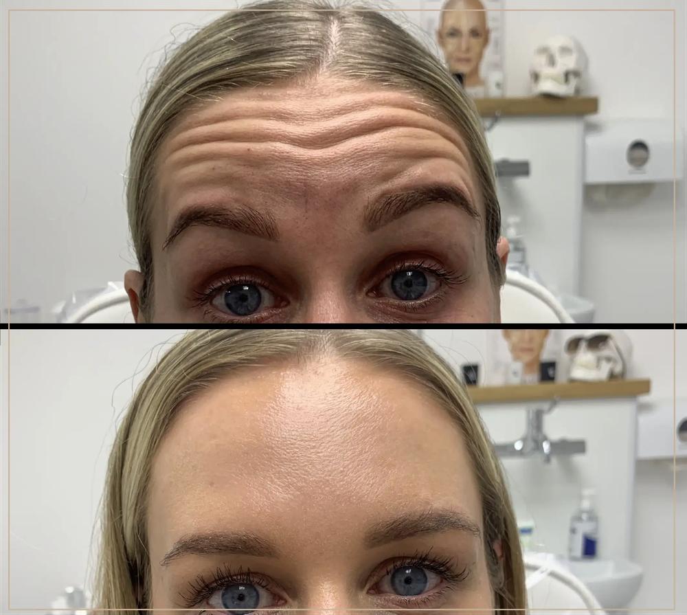 20 Units of Botox Before and After: Transformative Results