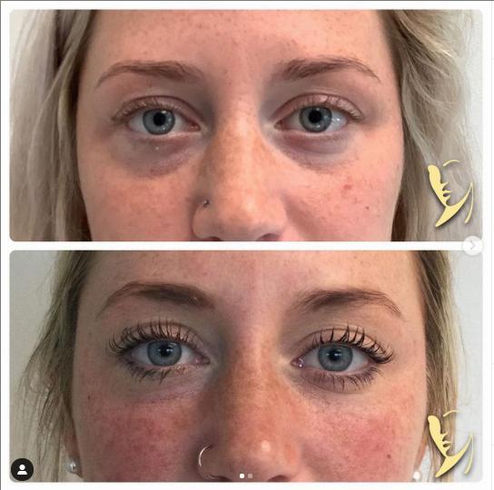 Botox Under Eyes Before and After: A Complete Guide