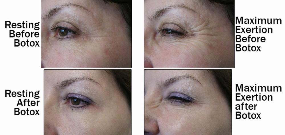 Under Eye Botox Before and After: Transformative Results