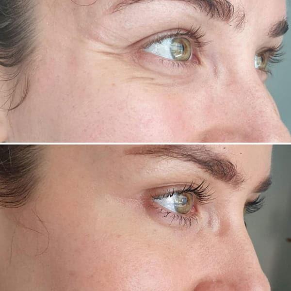 Botox on Eyelids Before and After: Transformative Effects Explained