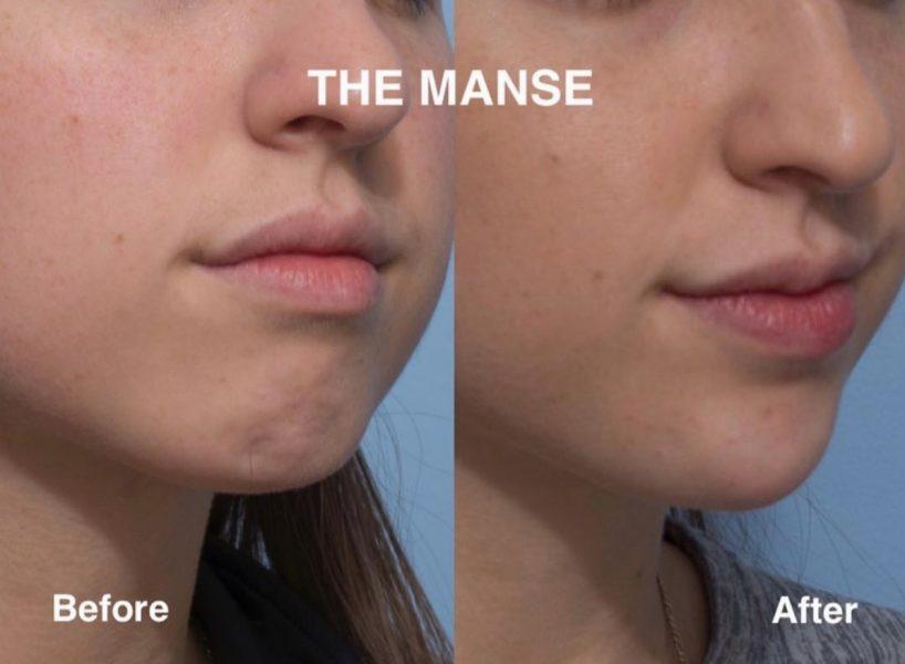 Botox in Chin Before and After: Complete Guide