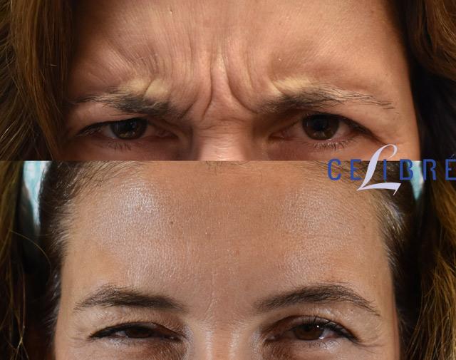 Botox for Smokers Lines Before and After