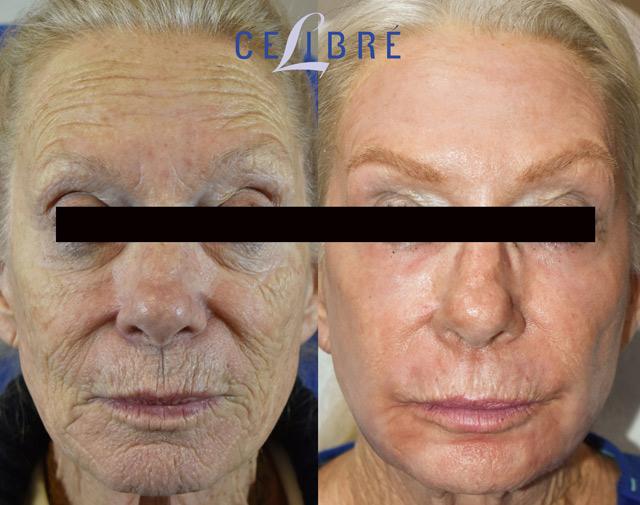 Upper Lip Botox for Smokers Lines Before and After: Complete Guide