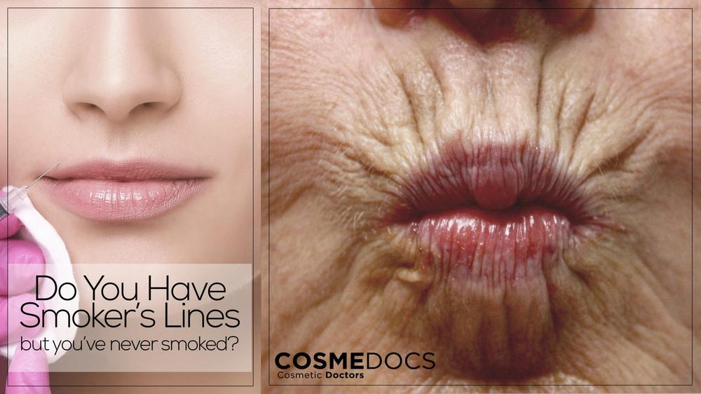 Upper Lip Botox for Smokers Lines Before and After: Complete Guide