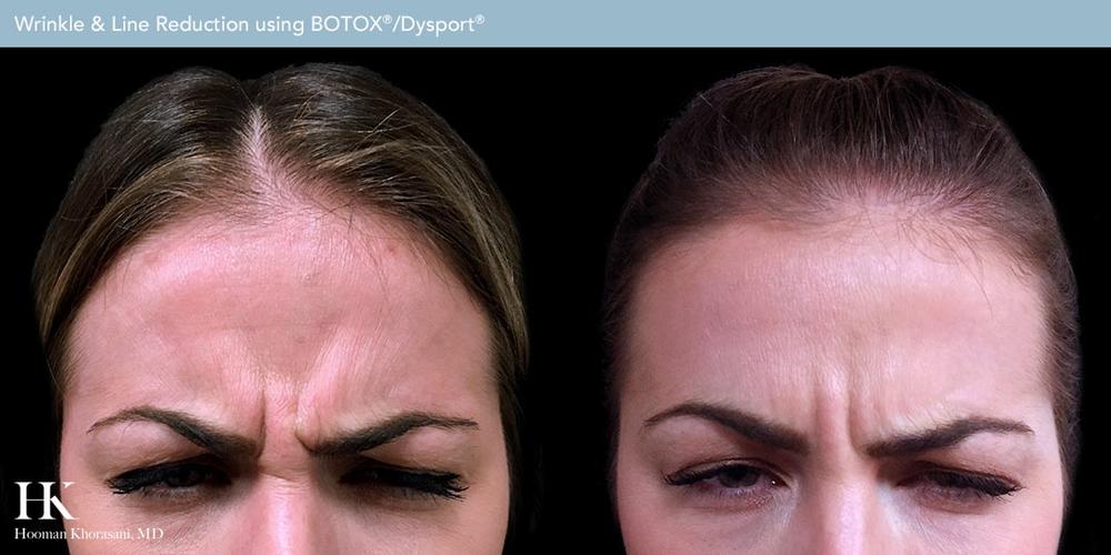 Botox in Forehead Before and After: Transformative Results