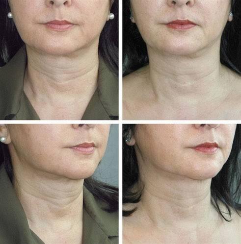 Botox in Neck Before and After: Complete Guide