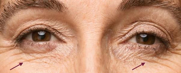 Botox Under Eye Before and After Guide