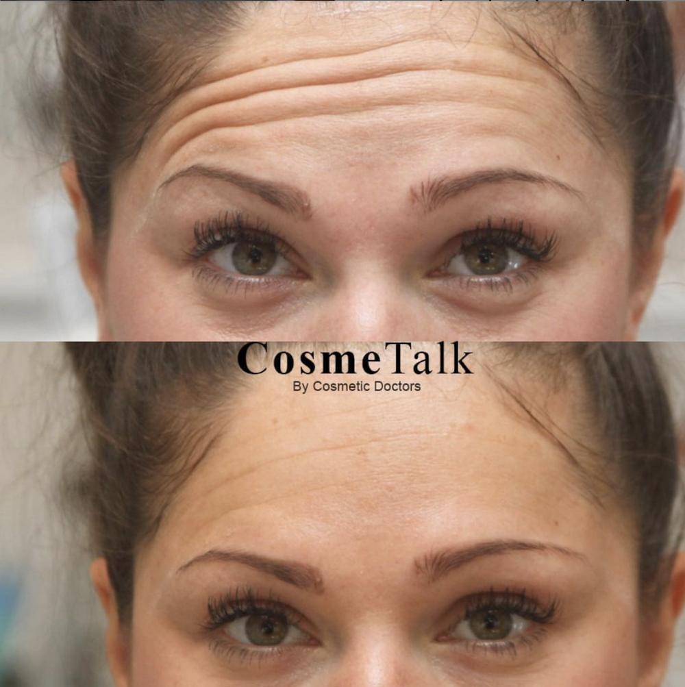 Cat Eye Botox Brow Lift Before and After: A Complete Guide