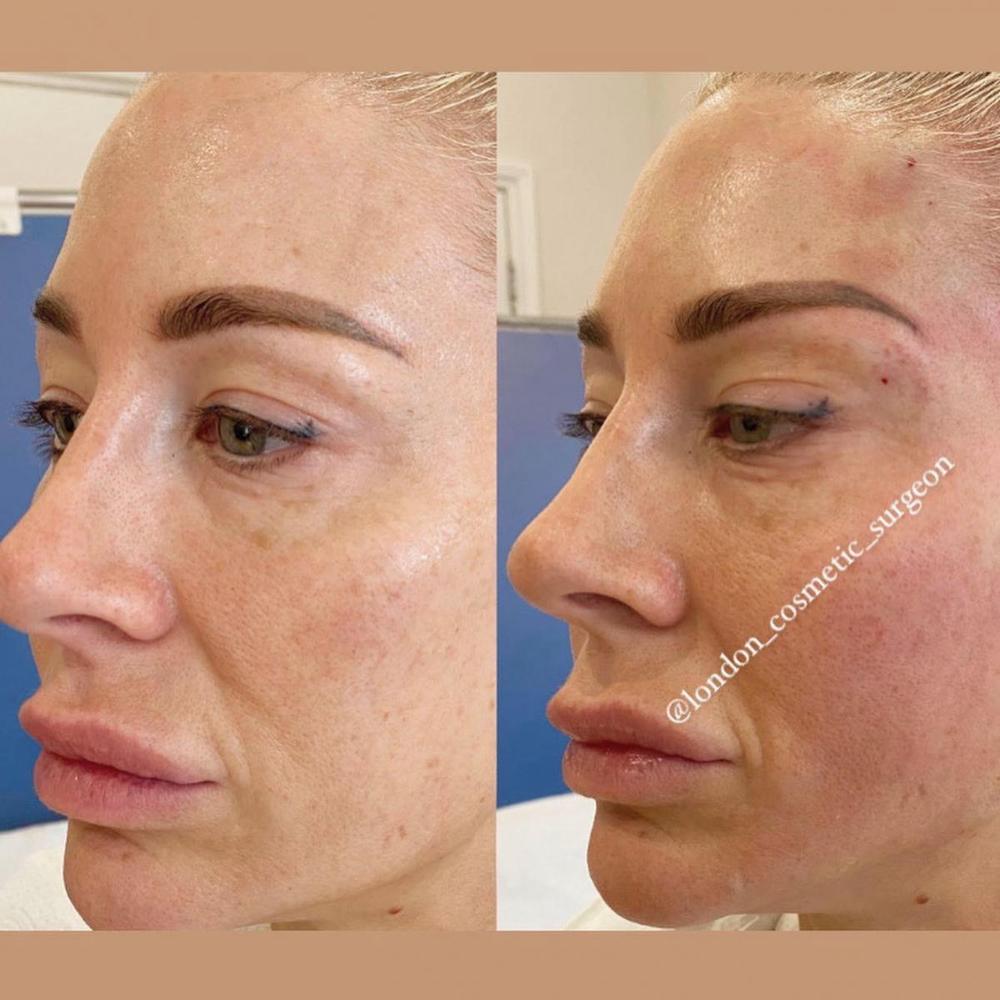 Cat Eye Botox Brow Lift Before and After: A Complete Guide