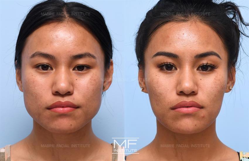 Botox Lower Face Before and After: Transformative Results
