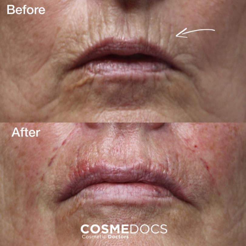 Botox for Smokers Lines Before and After