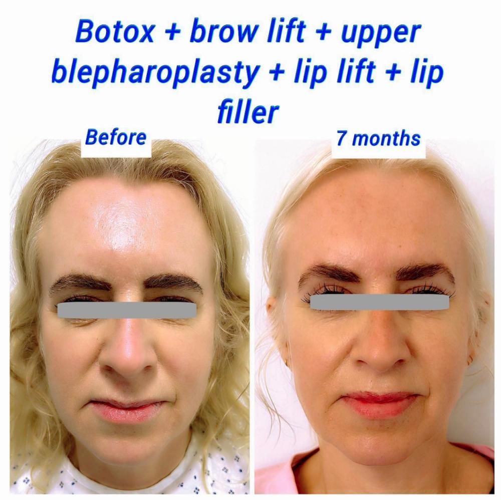 Botox Eyelid Lift Before and After: Transformative Results Guide