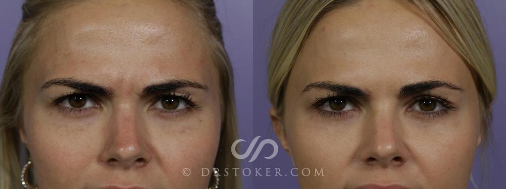 Botox Eyelid Lift Before and After: Transformative Results Guide