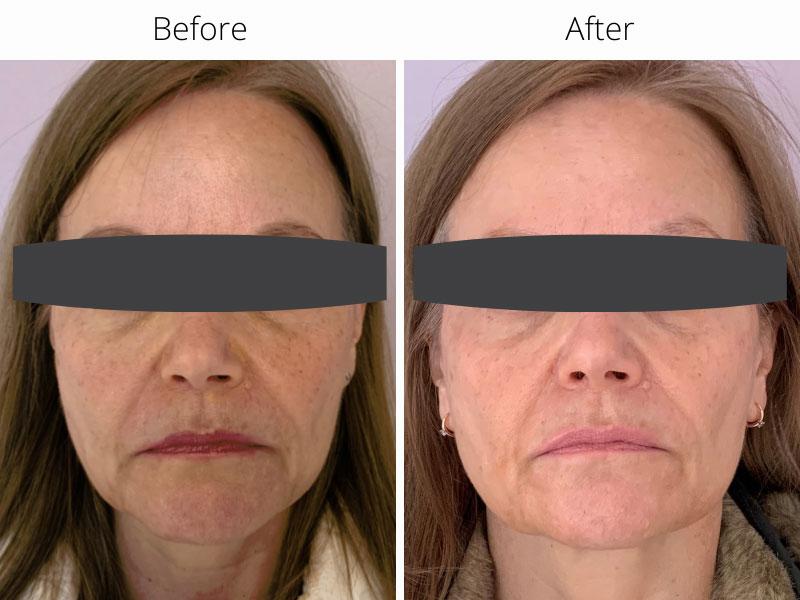 Botox for Marionette Lines Before and After: A Comprehensive Guide