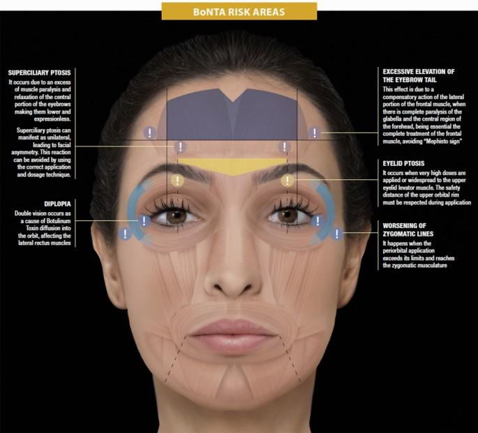 Botox for Gummy Smile Before and After: A Complete Guide