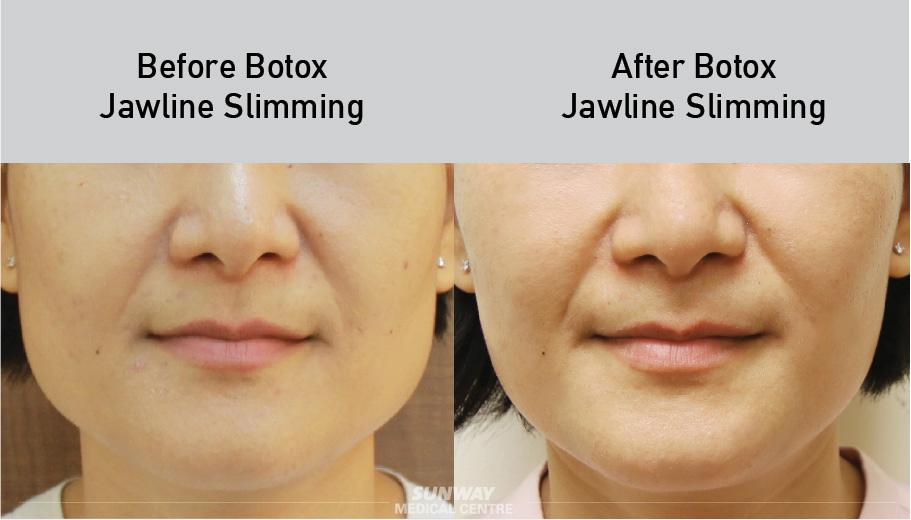 Botox in Jawline Before and After: Transformative Results