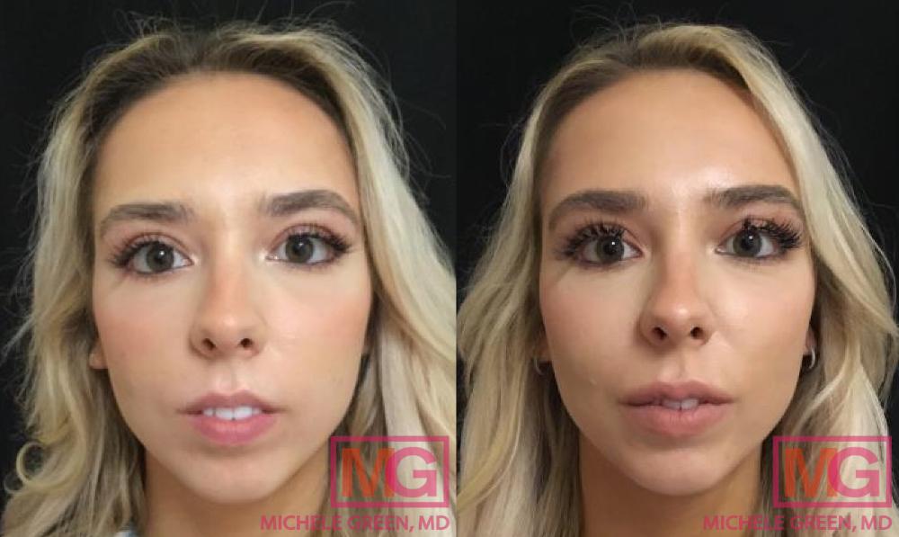 Botox on Jawline Before and After Transformation