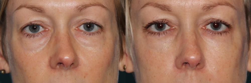 Before and After Botox Under Eyes: A Comprehensive Guide