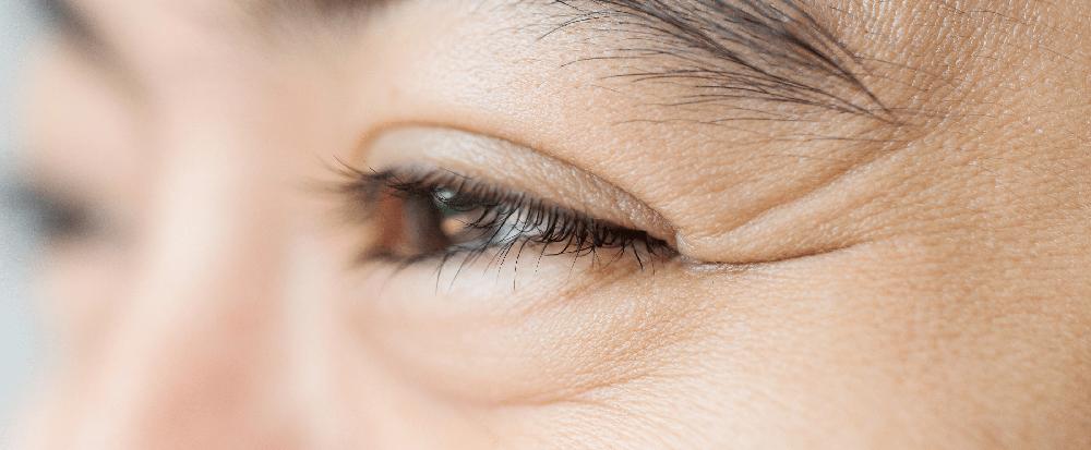 Botox for Crow's Feet Before and After