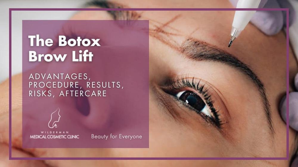 Brow Lift with Botox Before and After: A Comprehensive Guide