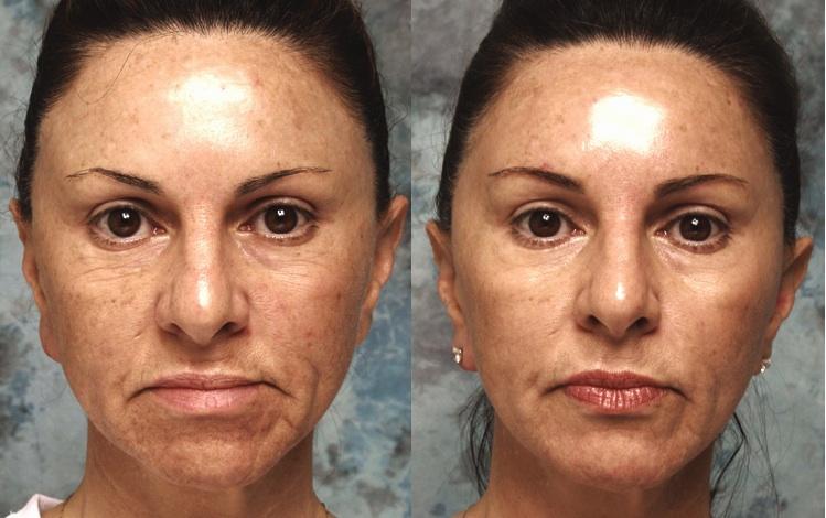 Nasal Flare Botox Before and After: Transform Your Facial Symmetry