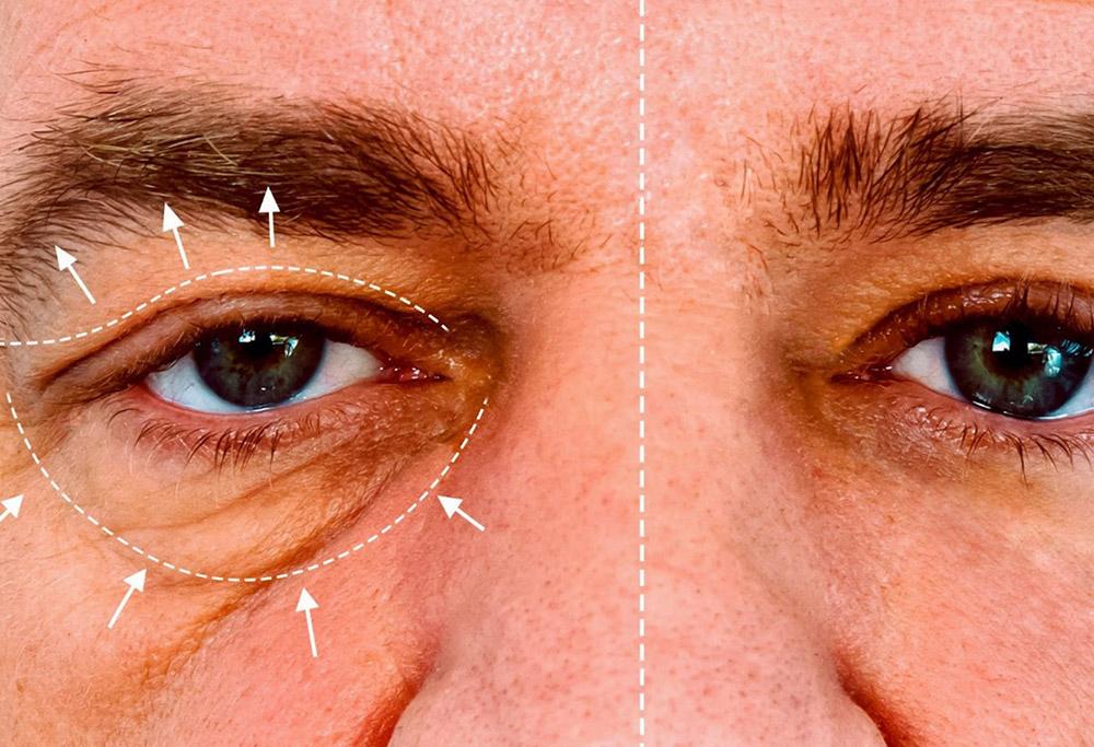 Botox for Under Eye Wrinkles Before and After Comparison