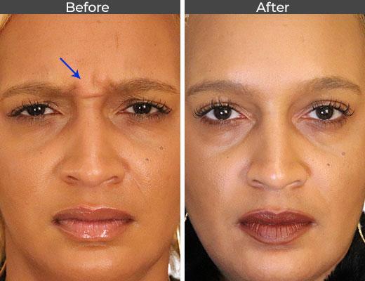 Botox Around Eyes Before and After: What to Expect