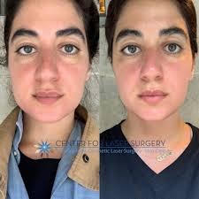 Botox for TMJ Before and After Pictures: A Visual Guide
